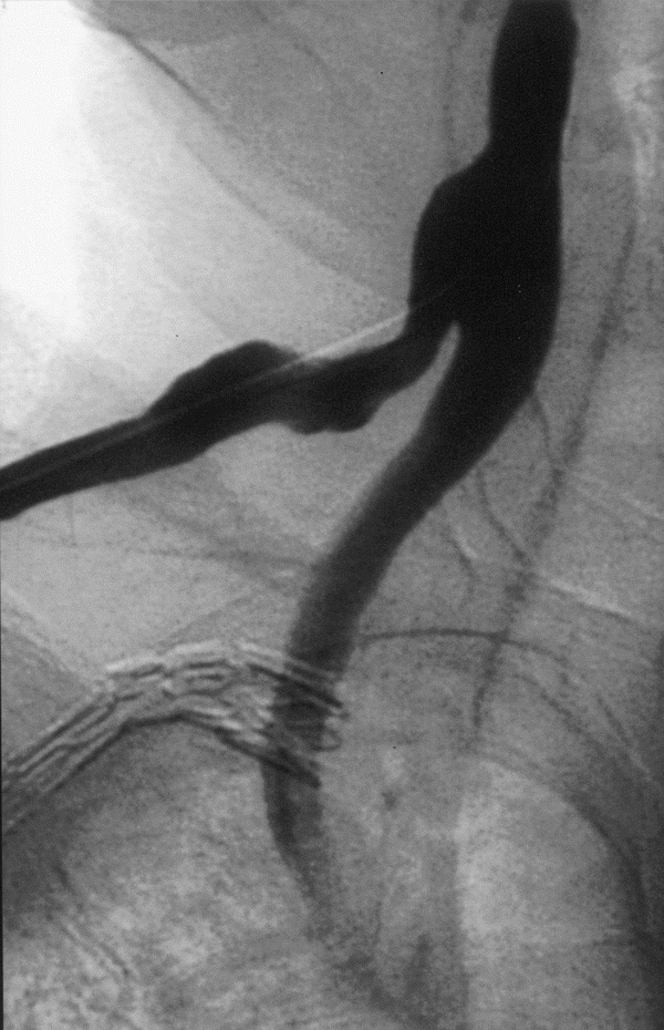 Cutting Balloon-Assisted Angioplasty of an Anastomotic Carotid-Brachial ...