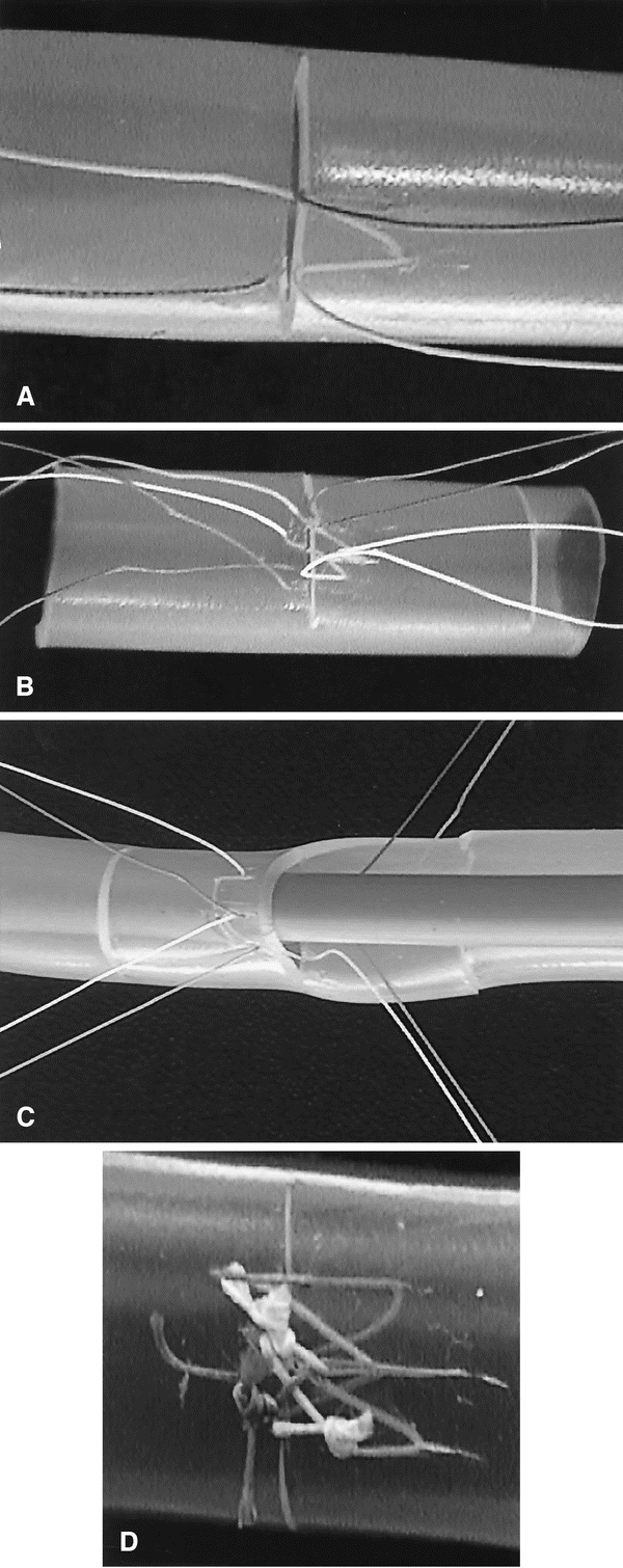 Percutaneous Femoral Closure Following Stent-Graft Placement: Use of ...