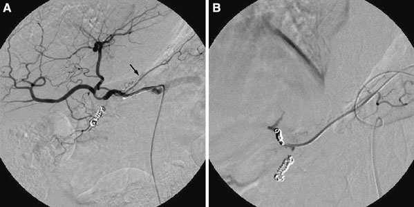 Right Gastric Artery Embolization Prior to Treatment with Yttrium-90 ...