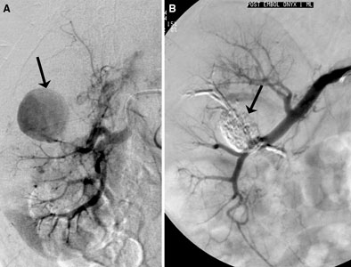 Onyx, a New Liquid Embolic Material for Peripheral Interventions ...