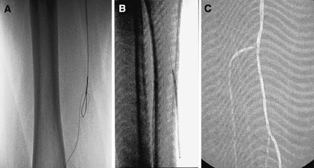 The “Safari” Technique to Perform Difficult Subintimal Infragenicular ...
