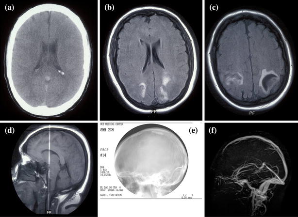 Cerebral Venous Congestion as Indication for Thrombolytic Treatment ...