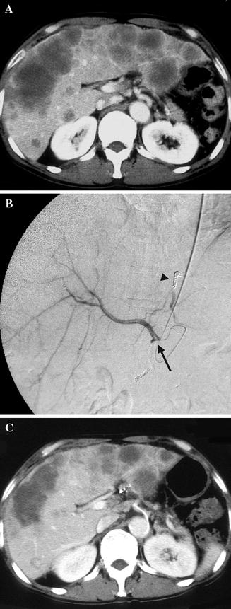 Hepatic Arterial Infusion Chemotherapy through a Port-Catheter System ...