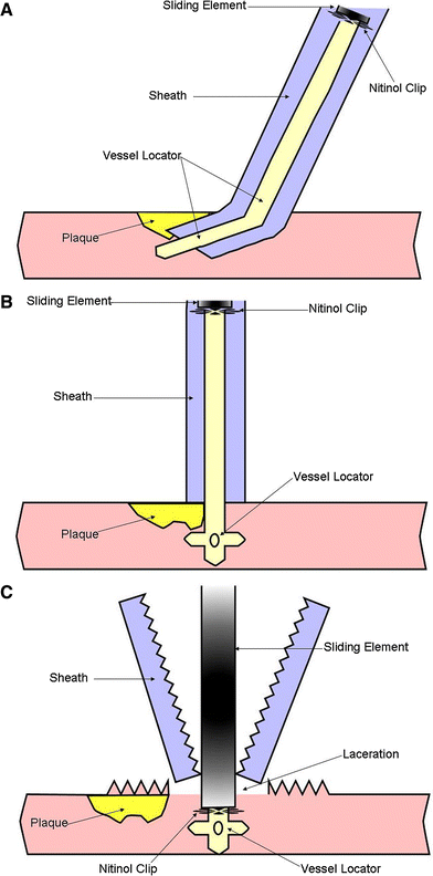 Laceration of the Common Femoral Artery Following Deployment of the ...