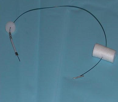 Removal of T-Fasteners 2 Days After Gastrostomy is Feasible | SpringerLink