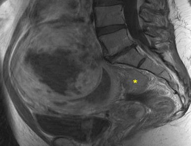 Utility of MRI Before and After Uterine Fibroid Embolization: Why to Do ...