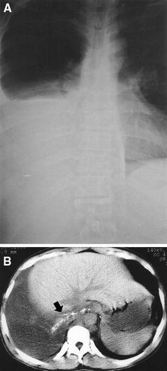 Lymphangiography in the Diagnosis and Localization of Various Chyle ...