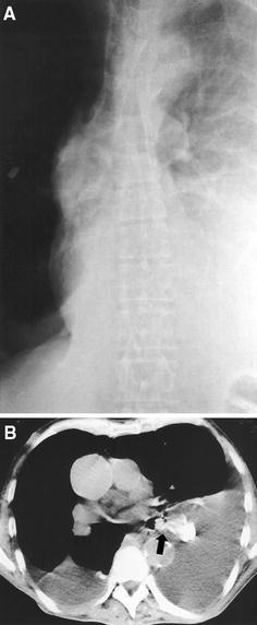 Lymphangiography in the Diagnosis and Localization of Various Chyle ...