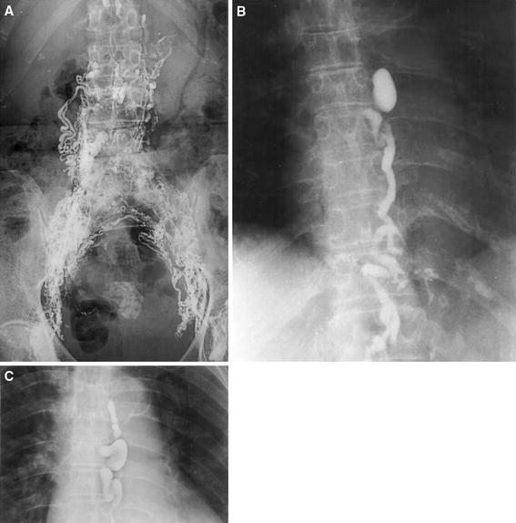 Lymphangiography in the Diagnosis and Localization of Various Chyle ...