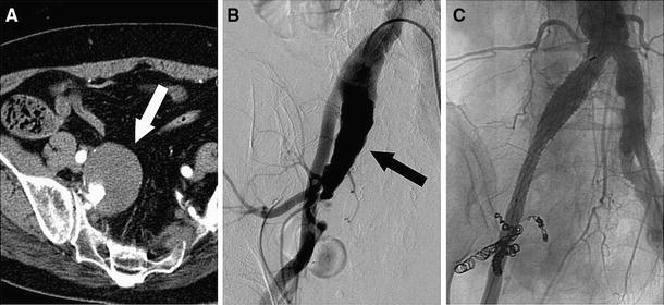 Endovascular Tubular Stent-Graft Placement for Isolated Iliac Artery ...