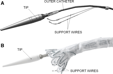 Relay NBS Graft with the Plus Delivery System to Improve Deployment in ...