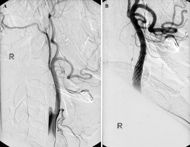 Carotid Stump Syndrome: Pathophysiology and Endovascular Treatment ...