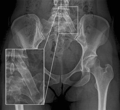 Endovascular Stent Treatment for Symptomatic Benign Iliofemoral Venous ...