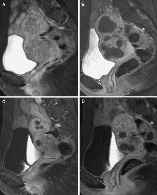 Midterm Results of Uterine Artery Embolization Using Narrow-Size ...
