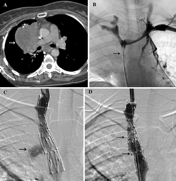 Successful Treatment of Superior Vena Cava Rupture with Placement of a ...