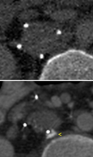 Perforation of the IVC: Rule Rather Than Exception After Longer ...