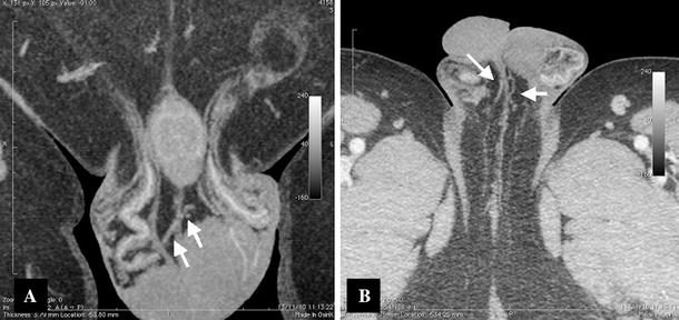 Interventional Radiology of Male Varicocele: Current Status | SpringerLink