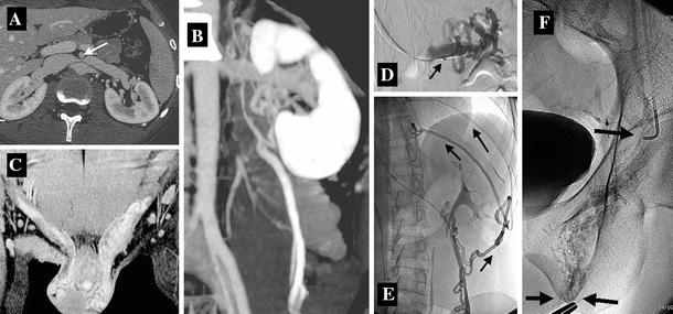 Interventional Radiology of Male Varicocele: Current Status | SpringerLink