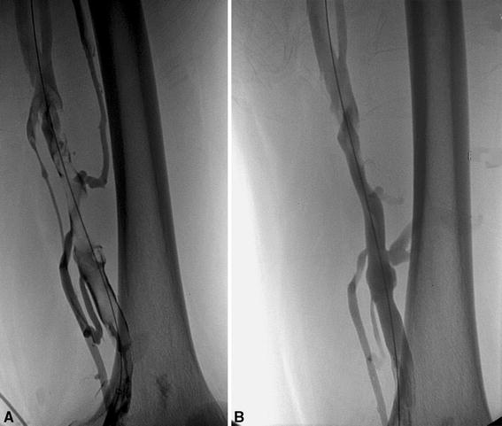 Catheter-directed Thrombolysis with Argatroban and tPA for Massive ...