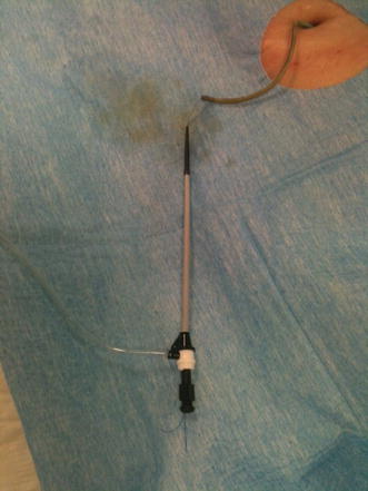 Safe Removal of an Encrusted Nephrostomy Tube Using a Vascular Sheath ...