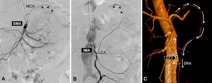 Inferior Mesenteric Artery Embolization Before Endovascular Aortic ...