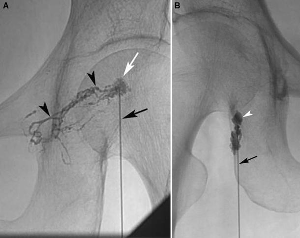 Intranodal Lymphangiogram: Technical Aspects and Findings | SpringerLink