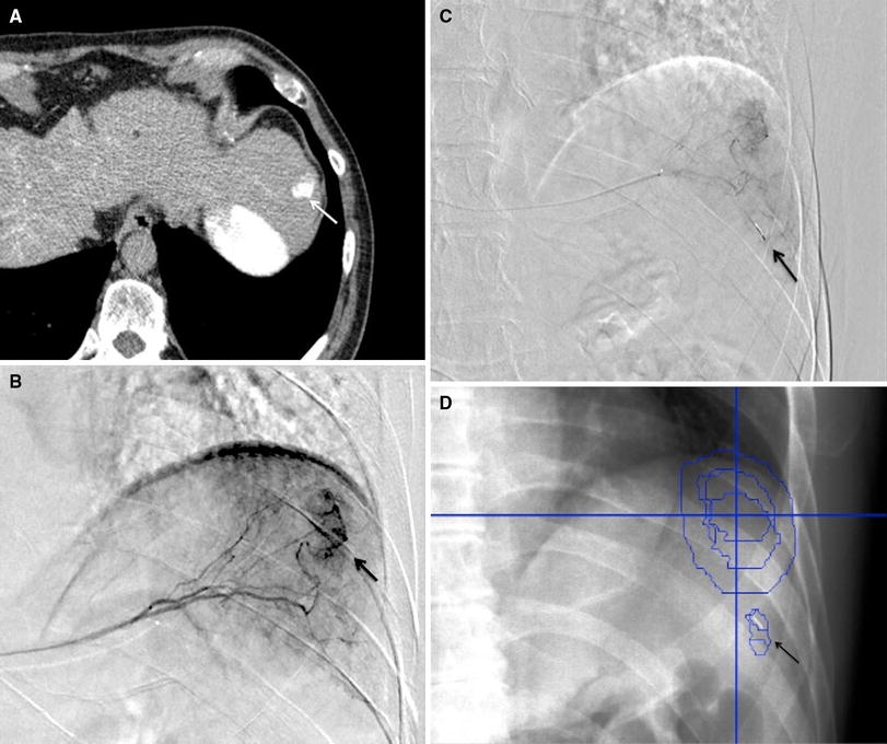 Transarterial Fiducial Marker Placement for Image-guided Proton Therapy ...