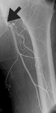 Use of Spider Filter Embolic Protection Device During Endovascular ...