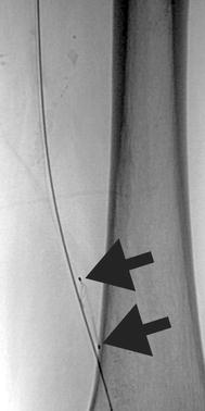 Use of Spider Filter Embolic Protection Device During Endovascular ...