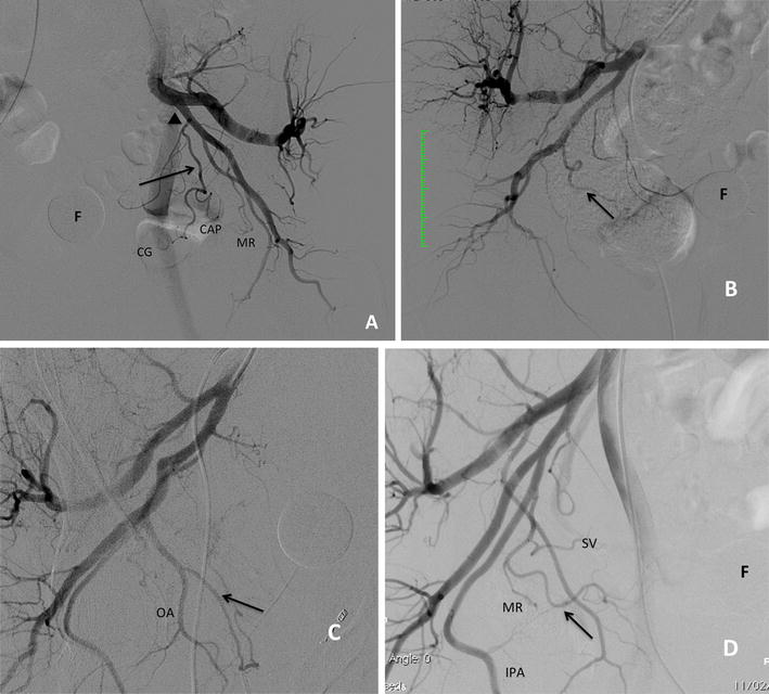 Pelvic Arterial Anatomy Relevant to Prostatic Artery Embolisation and ...