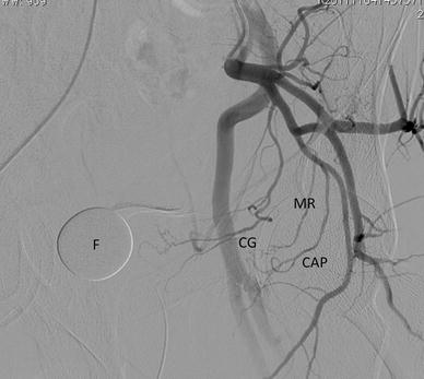 Pelvic Arterial Anatomy Relevant to Prostatic Artery Embolisation and ...