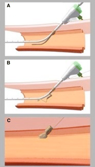 Vascular Closure Devices in Interventional Radiology Practice ...
