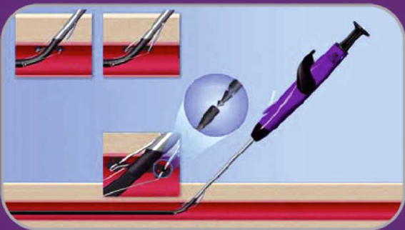 Vascular Closure Devices in Interventional Radiology Practice ...
