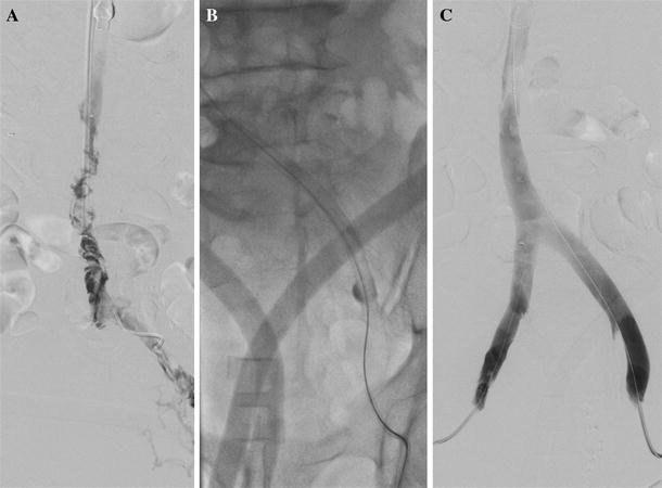 Single Center Experience with the AngioVac Aspiration System | SpringerLink
