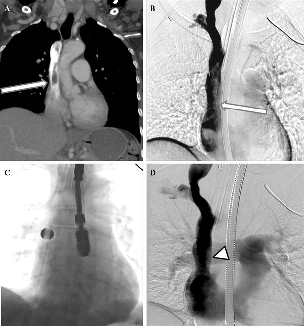 Single Center Experience with the AngioVac Aspiration System | SpringerLink