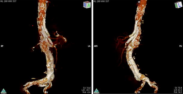 Endovascular Repair of a Type 1a Endoleak After Ch-EVAR with a b-EVAR ...