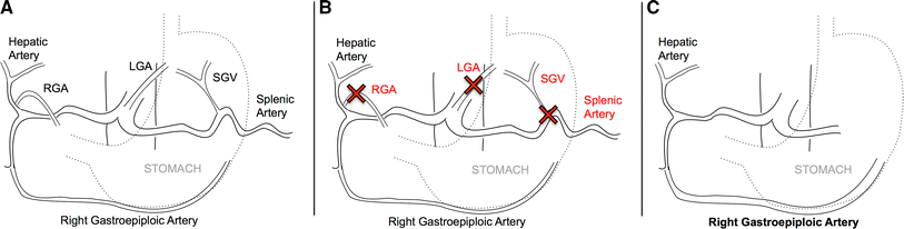 Ischemic Gastric Conditioning by Preoperative Arterial Embolization ...