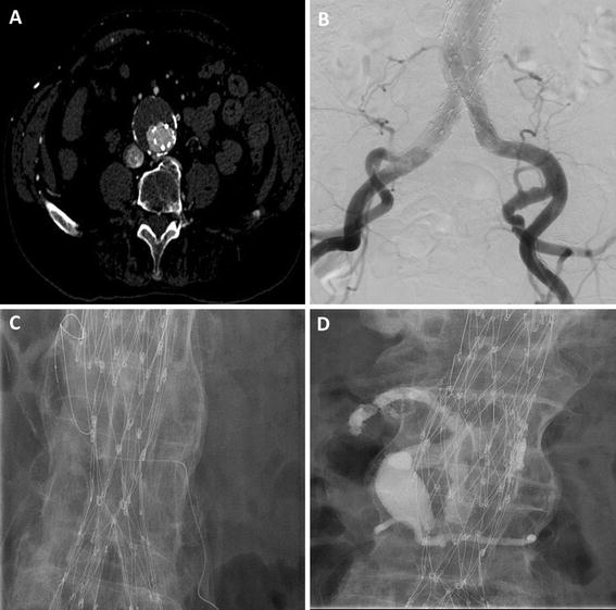 Treatment of Type II Endoleaks with a Novel Agent: Precipitating ...