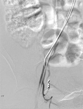 The Technique and Benefits of Angiographic Embolization of Inferior ...