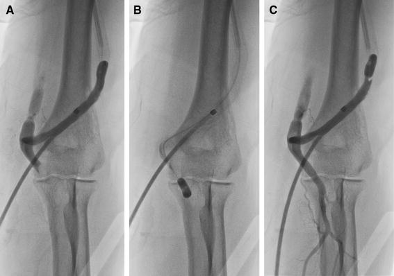 Arterial Embolism Occurring During Percutaneous Thrombectomy of ...