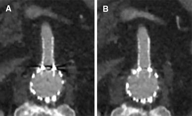 Evaluation of CT Angiography Image Quality Acquired with Single-Energy ...