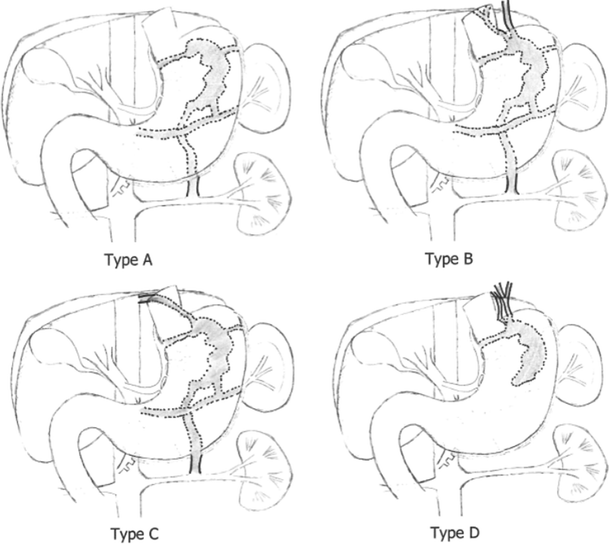 Modified Balloon-Occluded Retrograde Transvenous Obliteration (BRTO ...