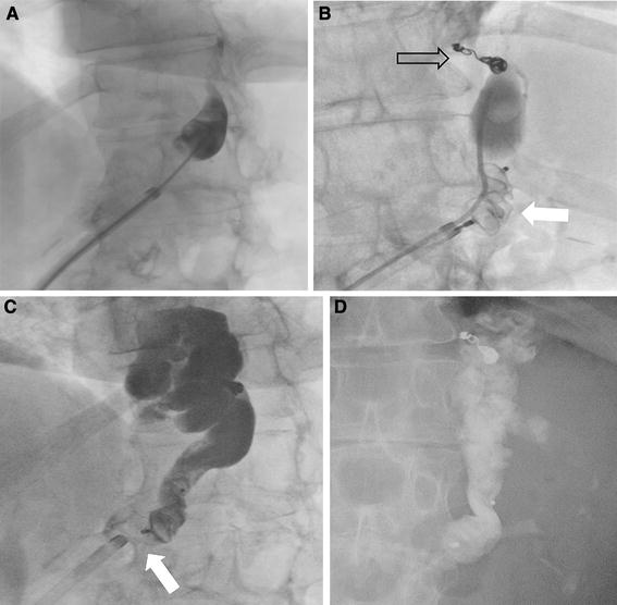 Modified Balloon-Occluded Retrograde Transvenous Obliteration (BRTO ...
