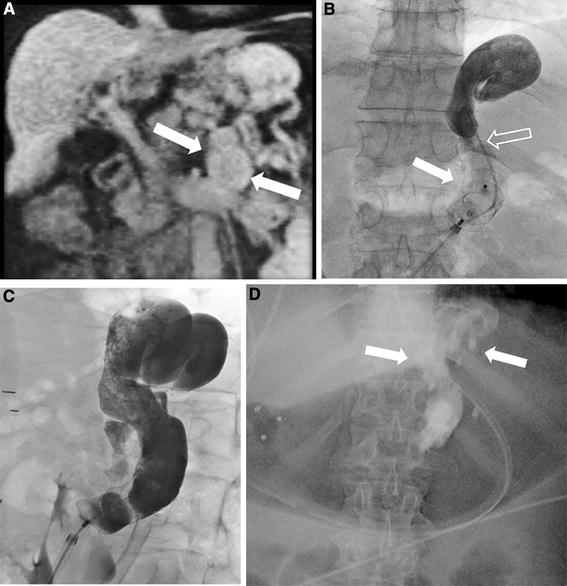 Modified Balloon-Occluded Retrograde Transvenous Obliteration (BRTO ...