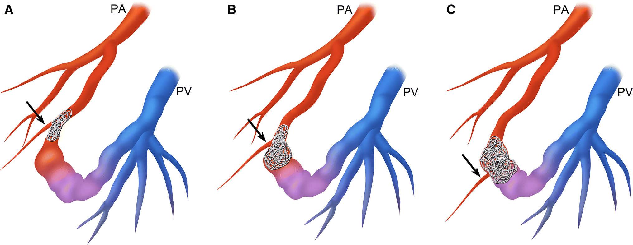 Where is the Origin of the Last Normal Branch from Feeding Artery of ...