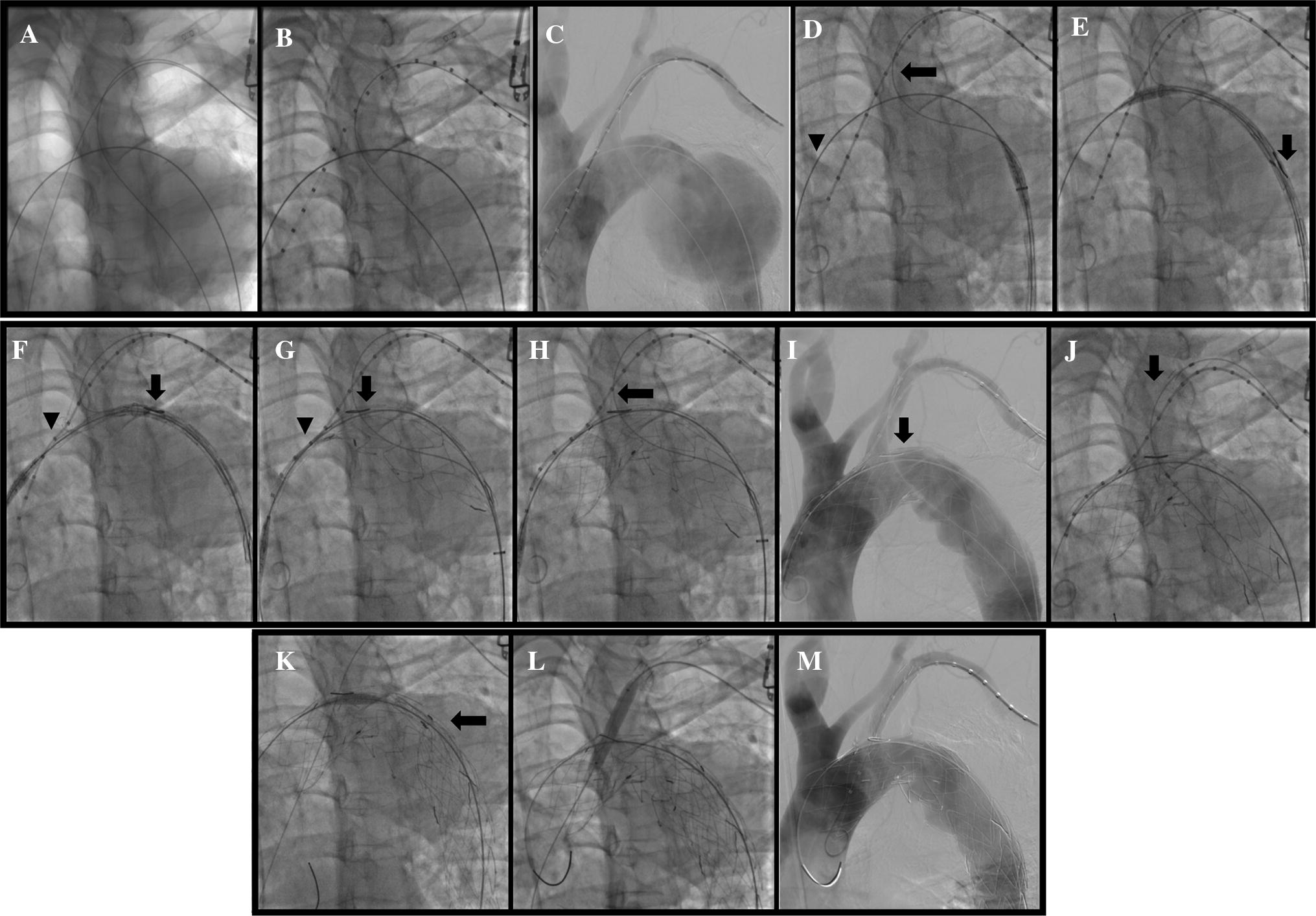 Two Wire System and Modified Olive Tip to Facilitate Implantation of ...