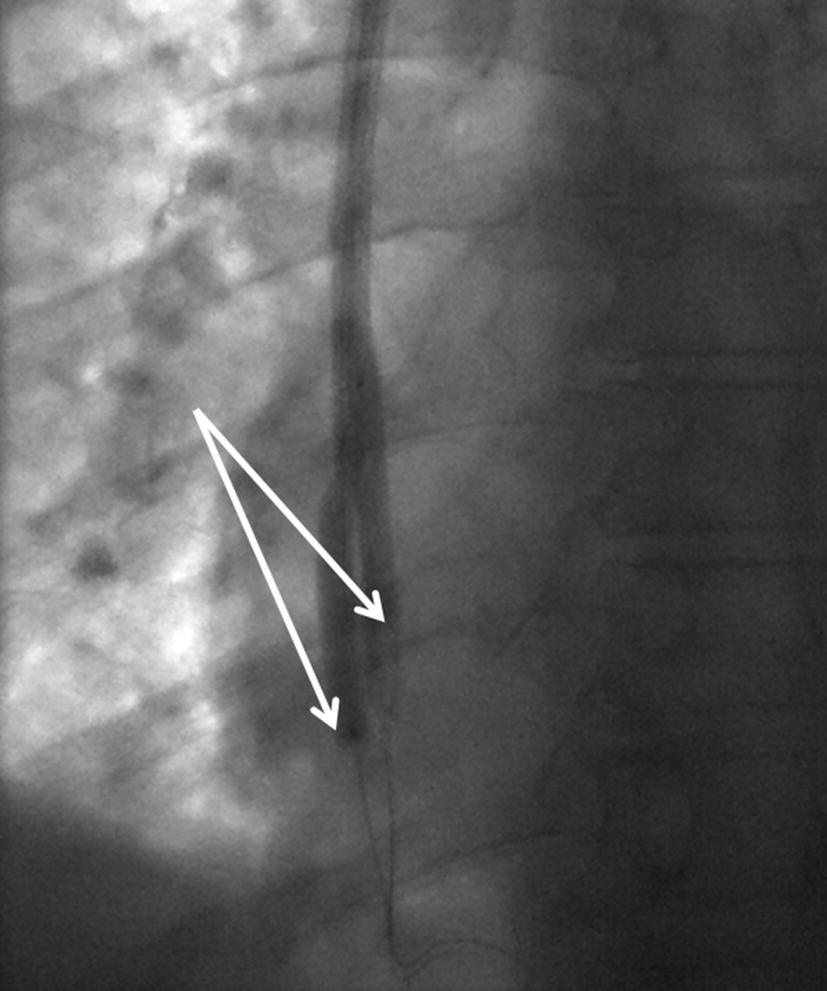 TuLIP (Tunnelled Line Intraluminal Plasty): An Alternative Technique ...