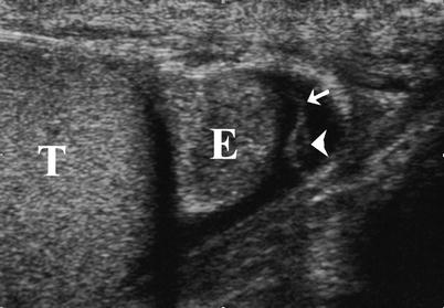 Cystic appendix epididymis: a sonomorphologic study | SpringerLink