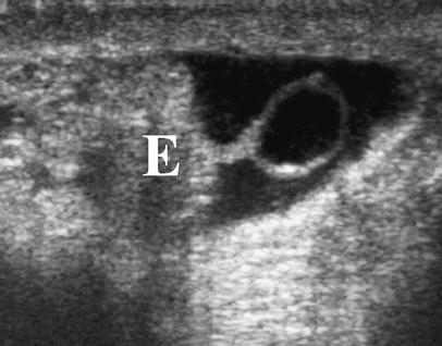 Cystic appendix epididymis: a sonomorphologic study | SpringerLink