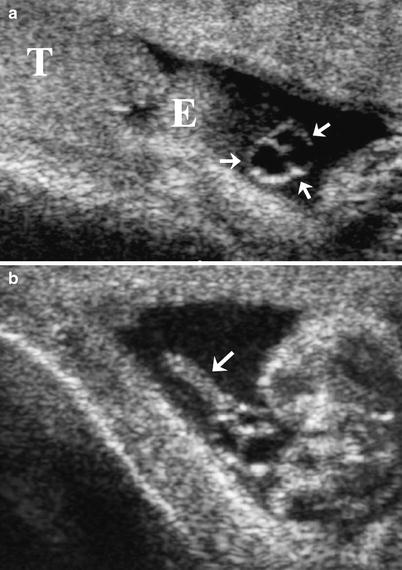Cystic appendix epididymis: a sonomorphologic study | SpringerLink